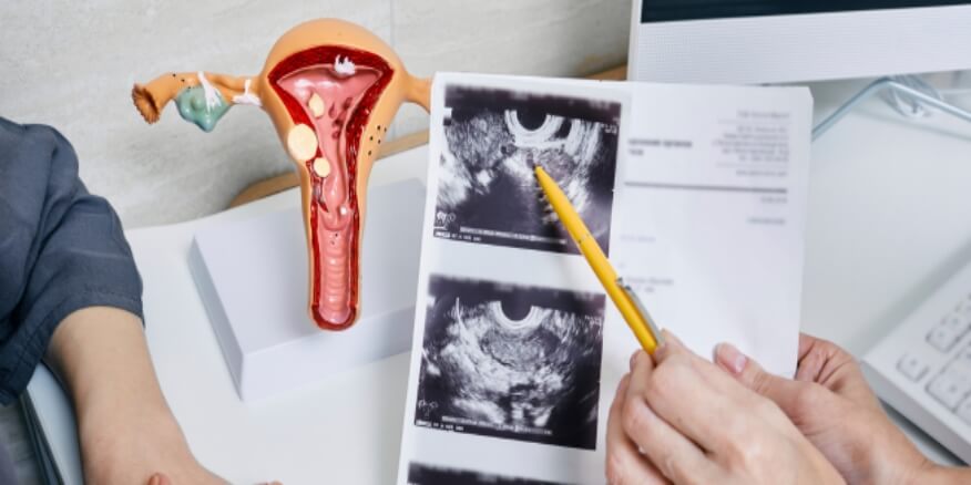 ما مدة علاج تكيس المبايض؟ - ويب طب